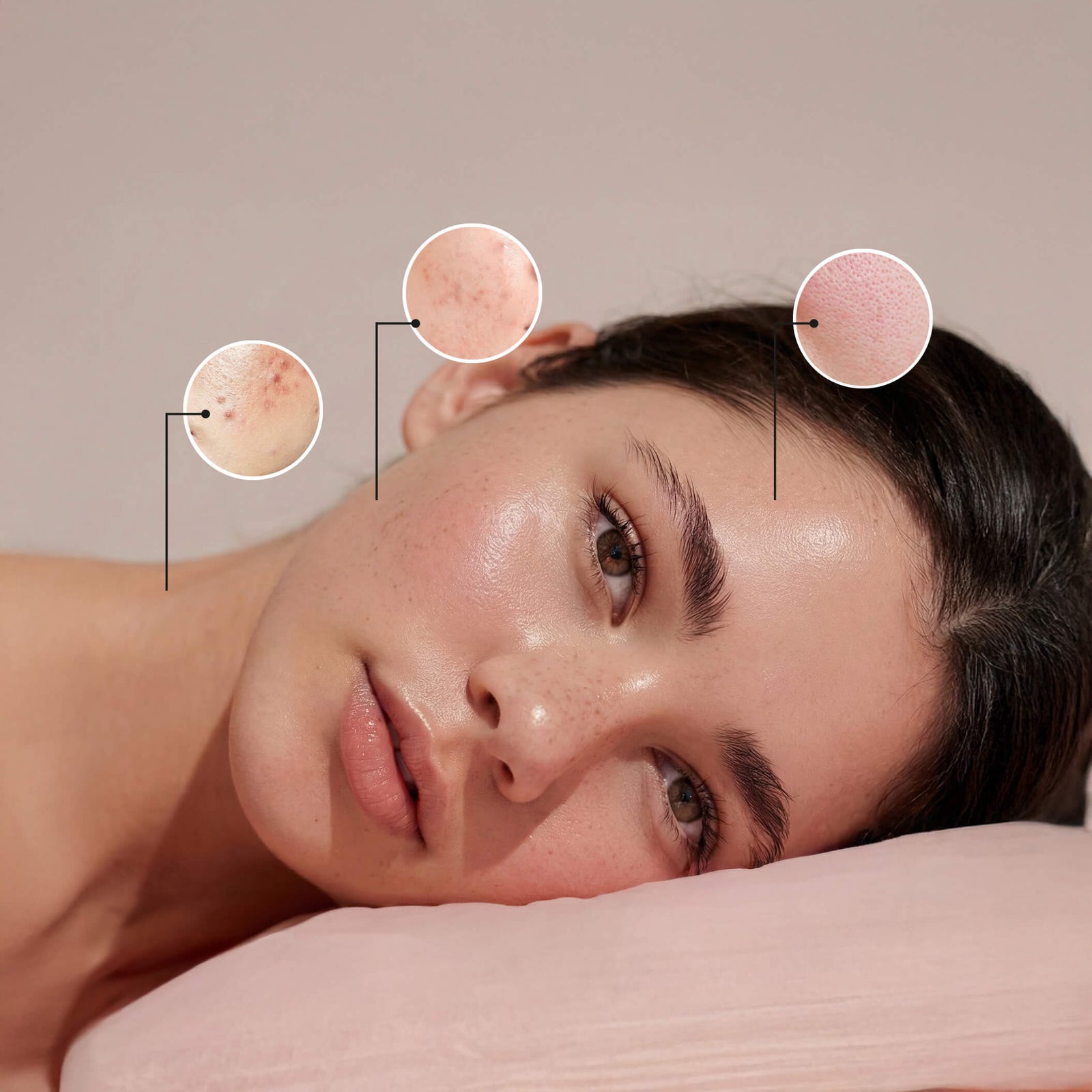 Acne – Organic Shop